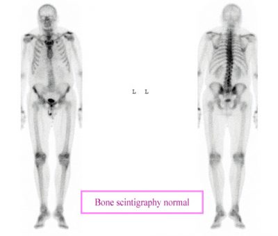 Bone Scintigraphies - radioactivity.eu.com
